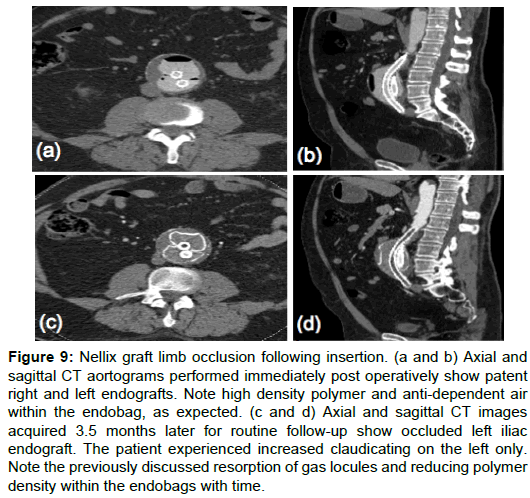 Nellix Endovascular Aneurysm Sealing System (EVAS): A New Concept in ...