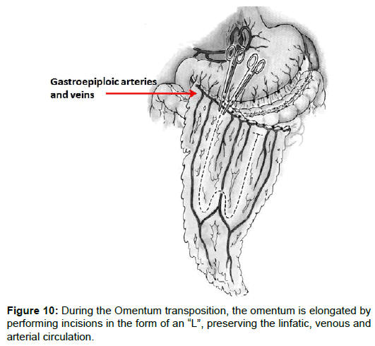 Moyamoya Disease in Childs and Adults: A Review of Surgical Treatment