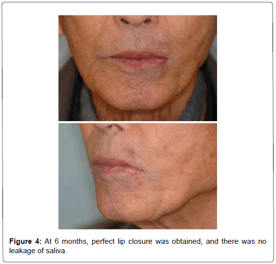 Lip Reconstruction with a Palatal Mucoperiosteal Graft
