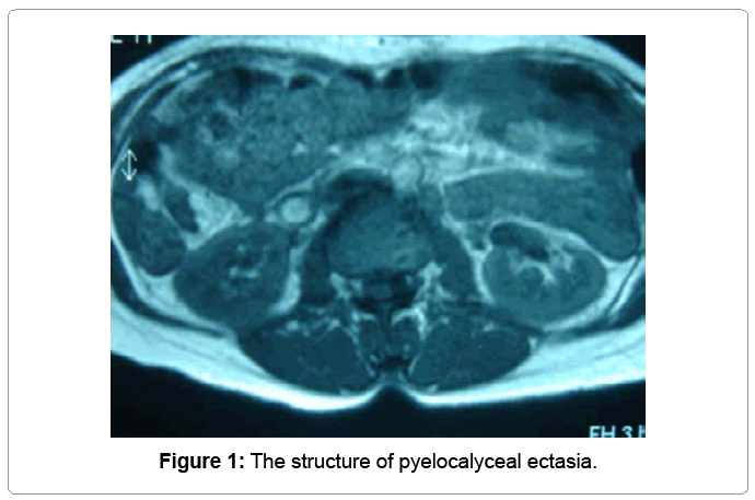 Ovarian Vein Thrombophlebitis: Case Report