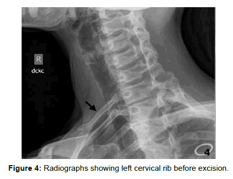Cervical Rib Causing Occlusion of the Subclavian Artery and Thora
