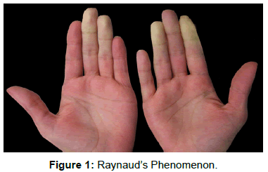 Nailfold Capillaroscopy: An Important Clinical Tool for the Vascu