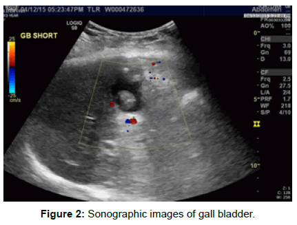 A Novel Approach: Trans-Cholecyctic PTC and Malignant Biliary Ste