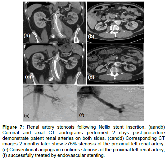 Nellix Endovascular Aneurysm Sealing System (EVAS): A New Concept in ...