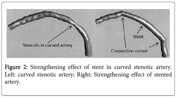 Research of Numerical Simulation of Biomechanics on In-stent-rest