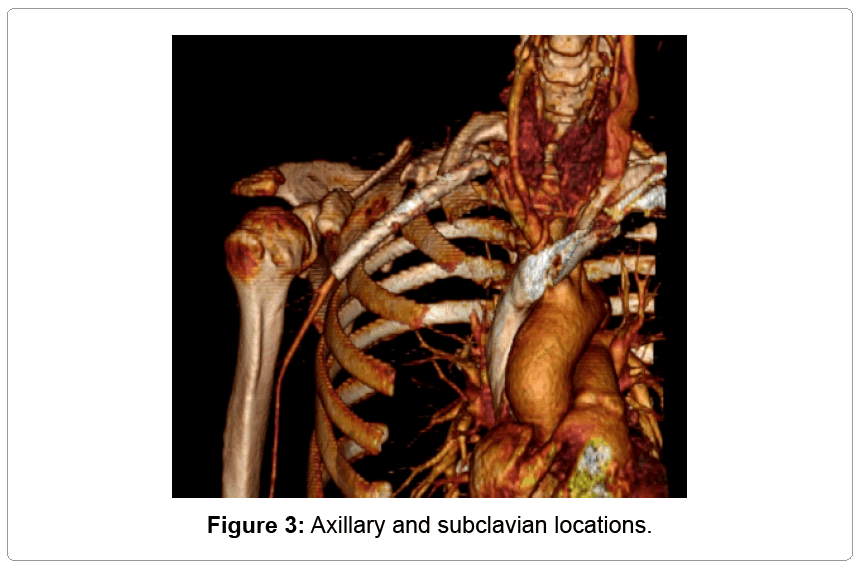 Endovascular Repair of Traumatic Subclavian Artery Injuries: A Single ...