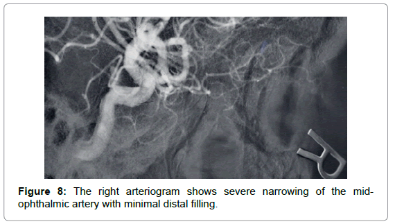 New Methods of Diagnosis and Treatment of Ophthalmic Artery Stenosis in ...