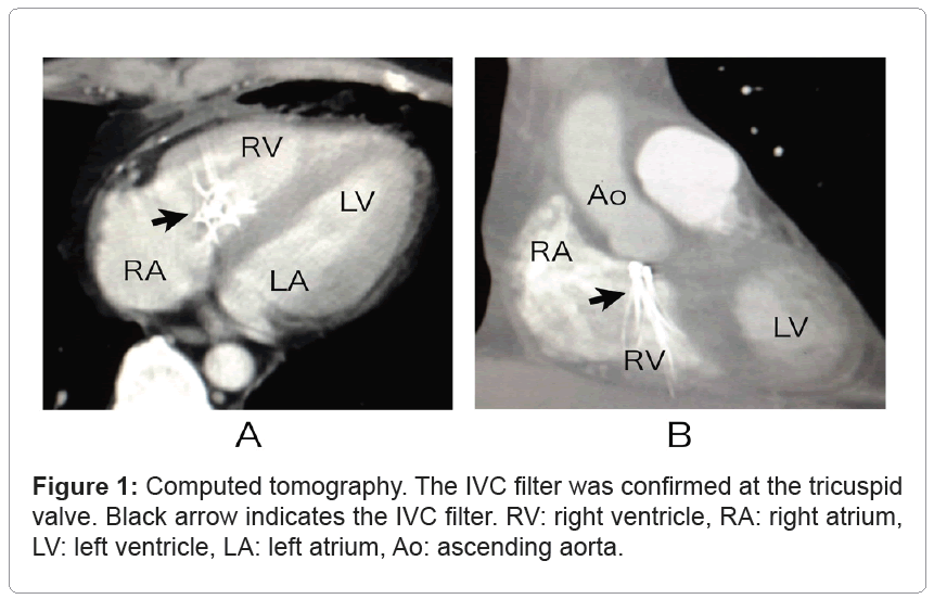 Life-threatening Migration of ALN Inferior Vena Cava Filter to Ri