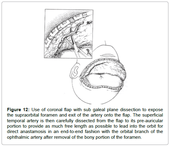 New Methods of Diagnosis and Treatment of Ophthalmic Artery Stenosis in ...