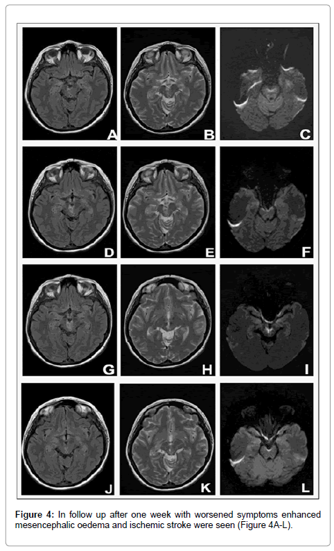 Neurovascular Compression Syndrome after Coiling Intracranial Ane